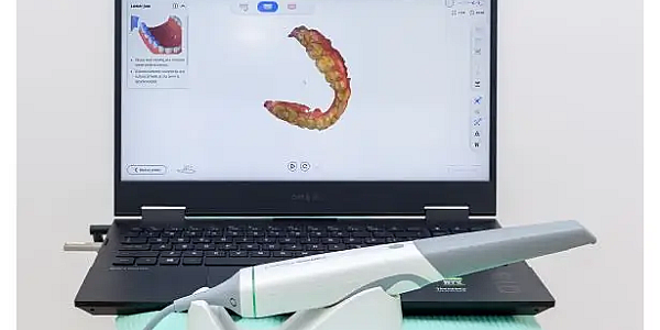 Intraoral Scanning Benefits | Dentarbre Dental Clinic