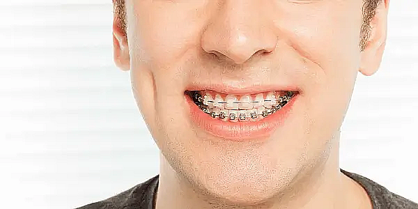 Sapphire braces store