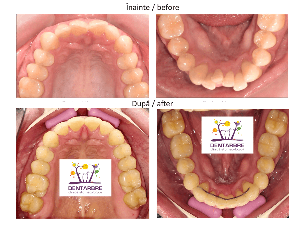 Dental Braces - Price, Types of Braces & Benefits | DentArbre